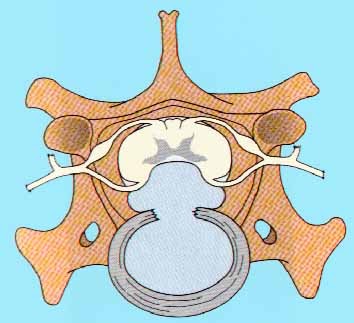 Hérnias de Disco Tipo I e II de Hansen | Mundo Ecologia