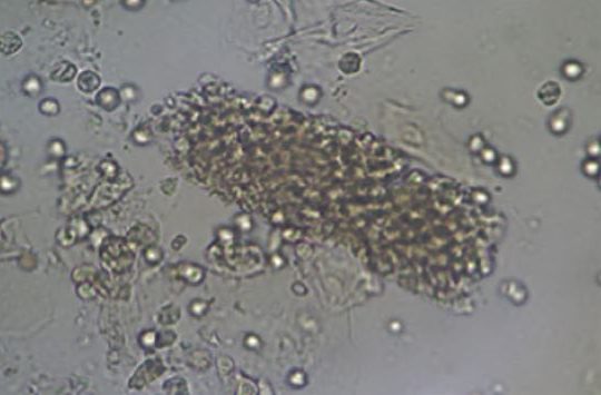 O Que Significa a Presença de Cilindros na Urina? | Mundo Ecologia