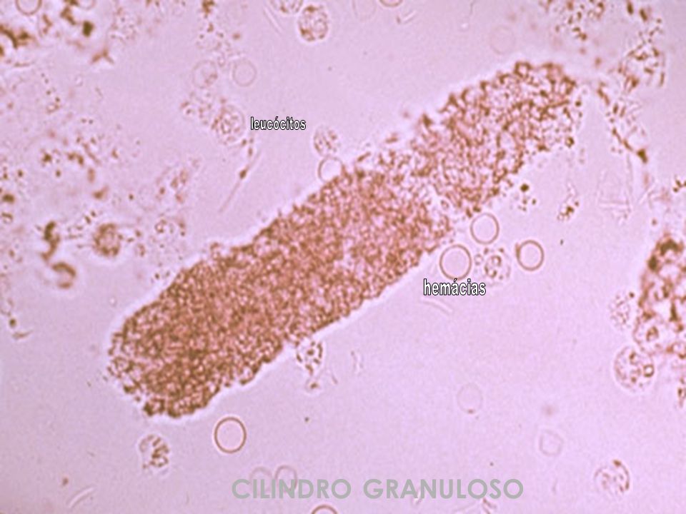 O Que Significa a Presença de Cilindros na Urina? | Mundo Ecologia